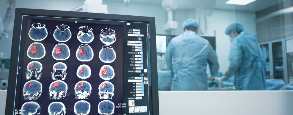 bg-brain-swelling - Astrocyte Pharmaceuticals